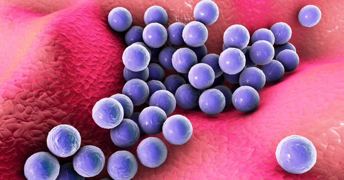Sepsis Misdiagnosis: When to Contact a Medical Malpractice Lawyer ...